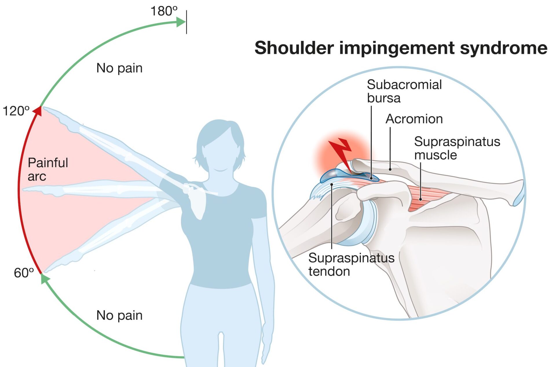 Shoulder Pain: Causes, Symptoms & Treatments - Mobilize Physiotherapy ...