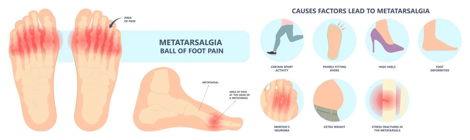 Why the Ball of Your Foot Might Be Hurting - Mobilize Physio